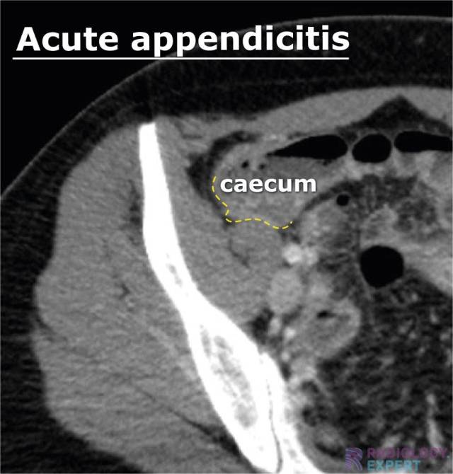 CT abdomen general